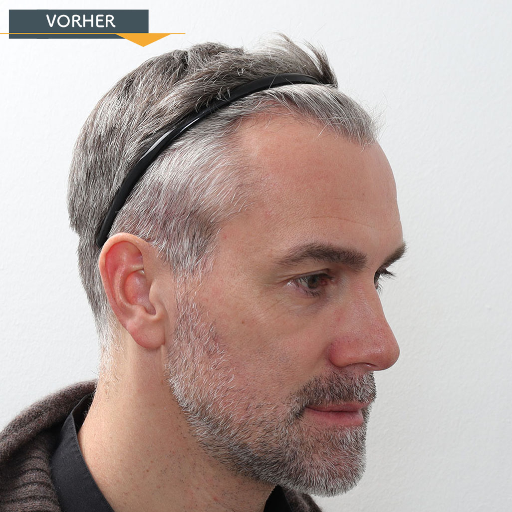 Haartransplantation von Stefan Maierhofer | Moser Medical